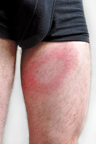 The Truth About Lyme Disease You Need To Know - Healthdish